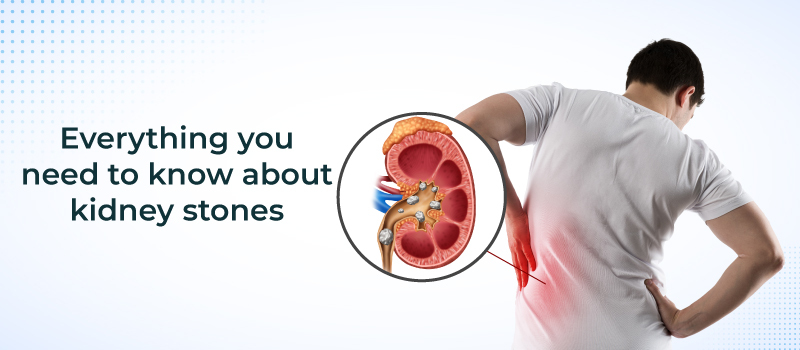 Everything you need to know about kidney stones | AINU